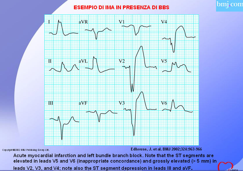 INFARTO ECG Azzolini Pier Lorenzo ecg